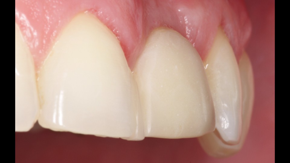 Greffes de gencive | Chirurgie implantaire | Dr Davarpanah