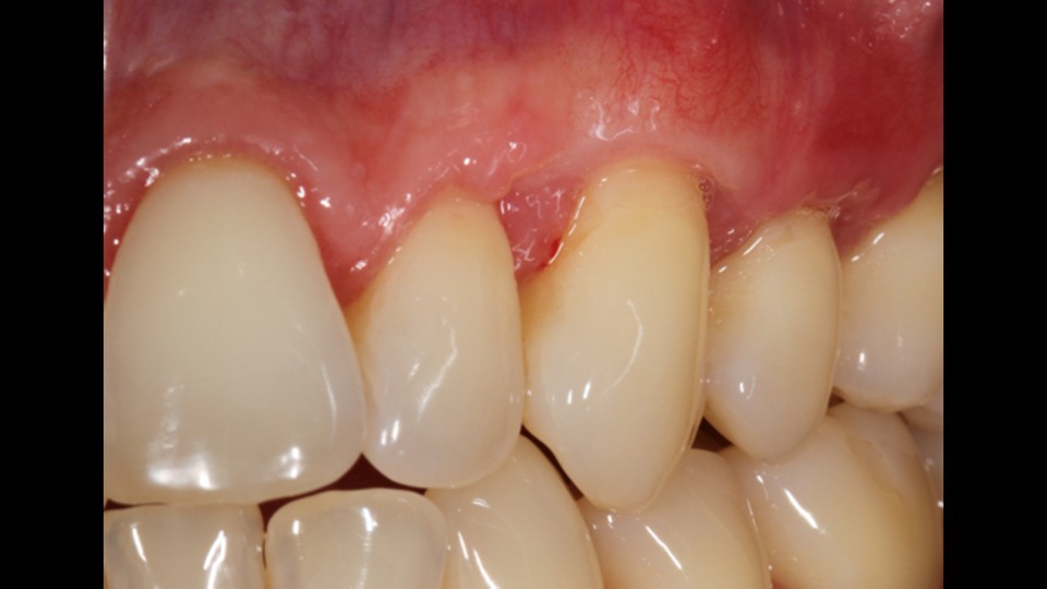 Greffes de gencive | Chirurgie implantaire | Dr Davarpanah