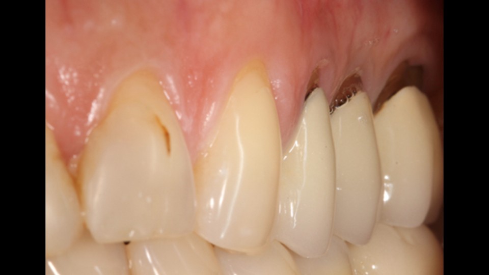 Greffes de gencive | Chirurgie implantaire | Dr Davarpanah