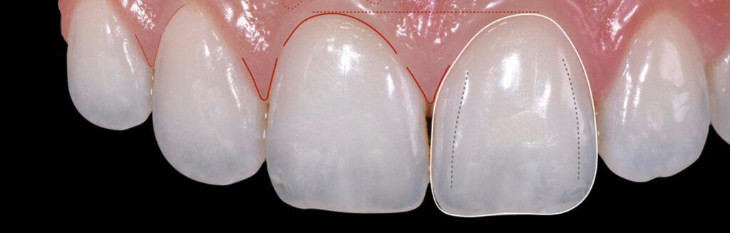 Esthétique et prothèse | Cabinet dentaire Dr Davarpanah