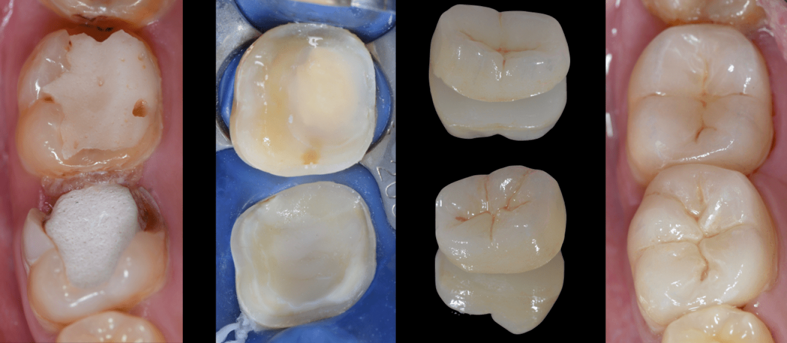 Inlays, onlays, overlays, couronnes | Cabinet dentaire Davarpanah