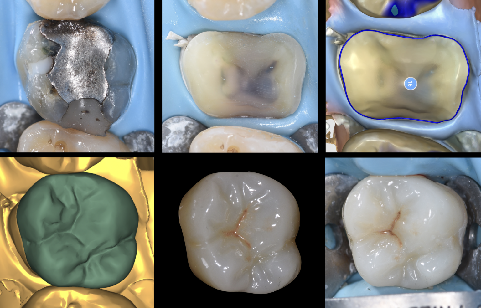 Inlays, onlays, overlays, couronnes | Cabinet dentaire Davarpanah
